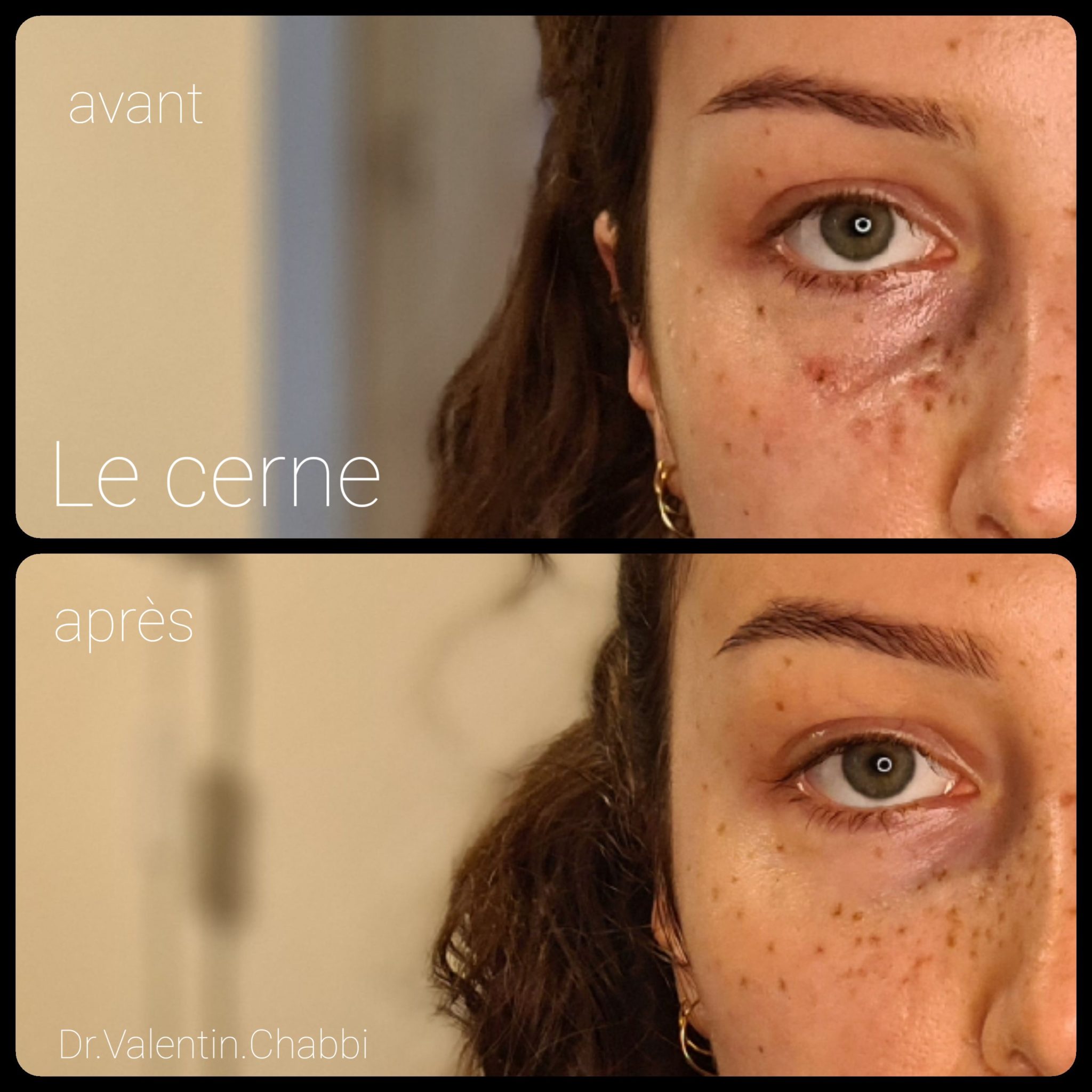 Le cerne - Docteur Chabbi